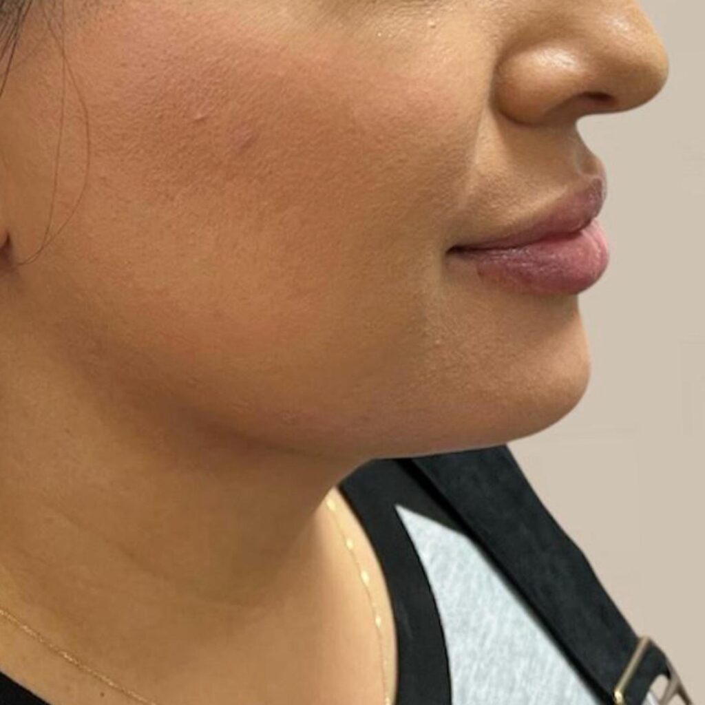Chin Liposuction Phoenix - Double Chin Removal & Jawline Contouring